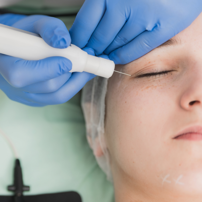 Skin Needling, the most effective dermal therapy for skin regeneration.